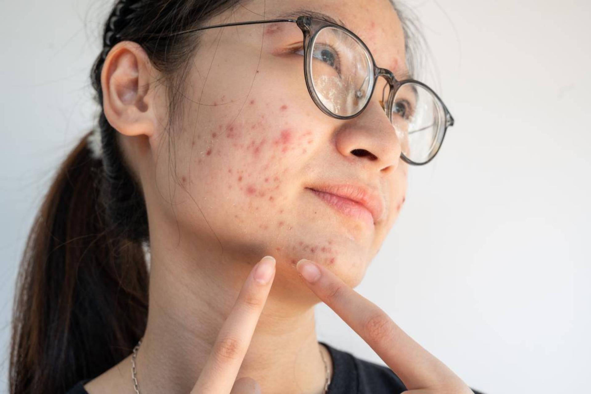 战痘宣颜丨不同性别，痘痘护理有讲究肌肤问题面部