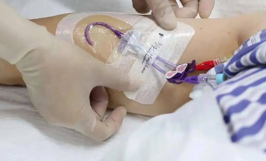 【办实事 解民忧】PICC专科门诊解决长期静脉置管患者反复穿刺难题_服务_导管_进行